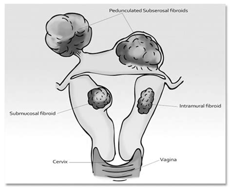 Uterine Polyps Vs Fibroids Uterine Fibroids Fibroid Uterine Fibroids