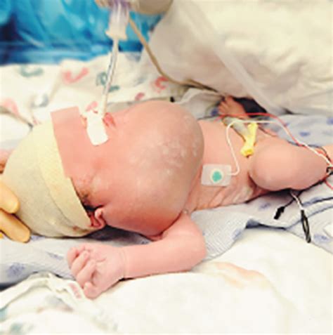 Fetal Head And Neck Masses Mri Prediction Of Significant Morbidity Ajr
