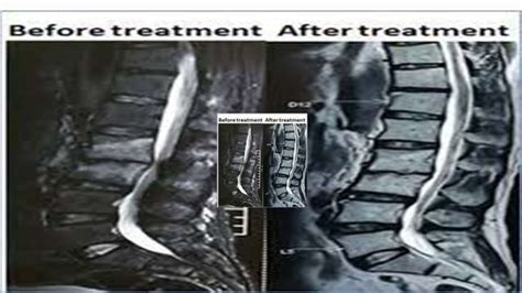 Potts Spine Tuberculosis Spine Tb Spine Pptx Bone And Joint