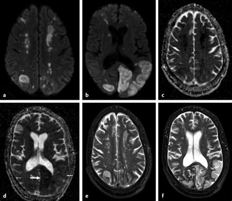Brain Edema Pathophysiology Radiology Key