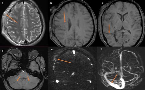 A T2w Axial Images Show Evidence Of Fluid Fluid Levels Within The