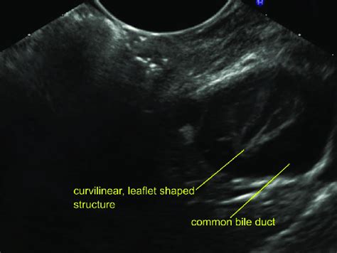 Another Linear Eus View From Stomach Showing Curvilinear Download