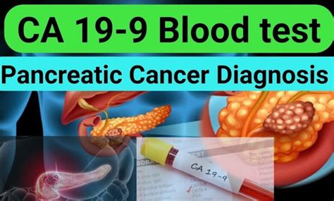 Understanding Ca 19 9 Its Role And Limitations In Pancreatic Cancer Management