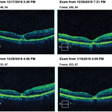 Oct Picture Of The Dynamics Of The State Of The Macular Zone After Download Scientific Diagram