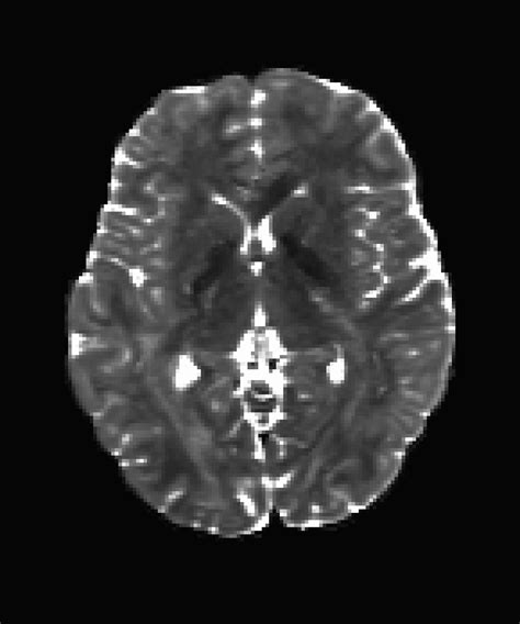 Tensor2metric Question Mrtrix3 Community