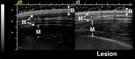 17 Year Old Girl With Generalized Morphea That Began Over 13 Years Download Scientific Diagram