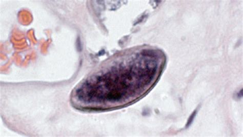 Can You See Pinworm Eggs