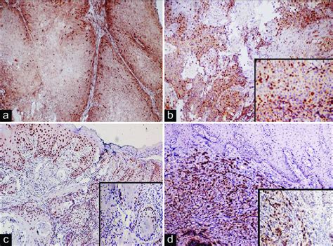 Immunopositivity Of Survivin A Showing Nuclear Localization In