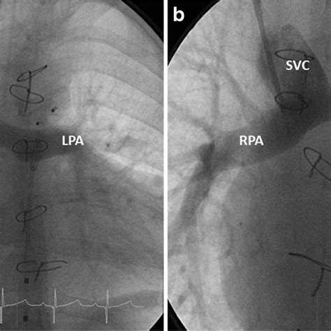 Stage Ii Selected Cineangiographic Frames Showing Bilateral