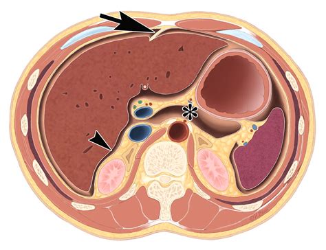 Cancer In The Peritoneum Peritoneal Cancer A Rare Abdominal Cancer