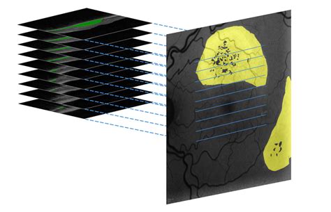 Spatial Relationship Between Srf Green In 3d Oct B Scans And Hf