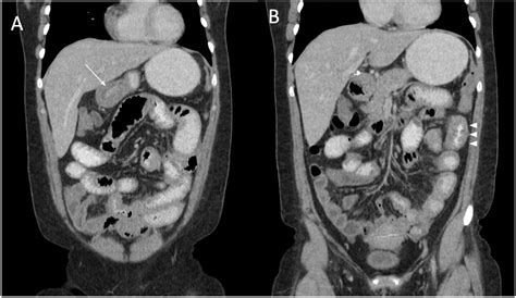 Eosinophilic Enterocolitis In Duodenum Ileum And Colon A Case Report
