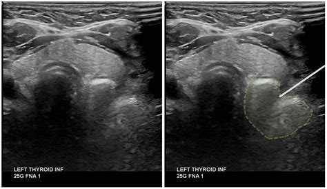 Aaron Rutman Md On Twitter Given Deformable Nodule Dirty