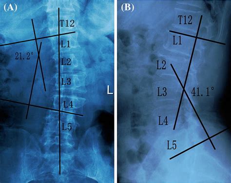 Male 75y Degenerative Lumbar Scoliosis A Showing That Apical