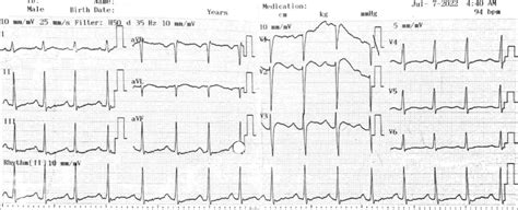 Twelve Lead Electrocardiogram Showing Sinus Rhythm And A Prolonged Qt