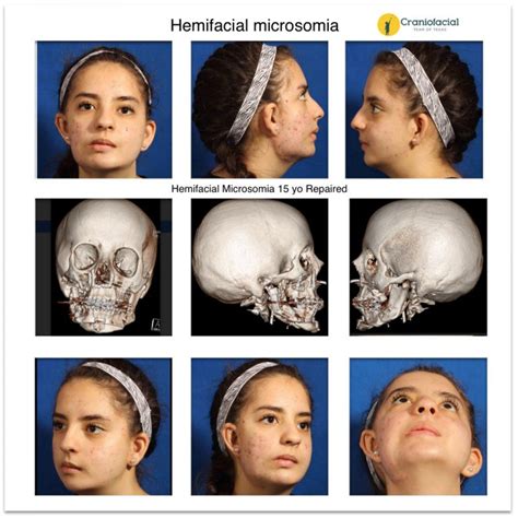 Hemifacial Microsomia Gallery Earwell Center Of Excellence