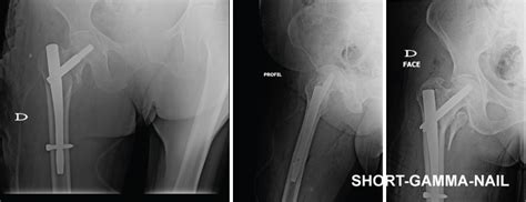 Hip Fracture Of The Elderly Orthopédie Sousse