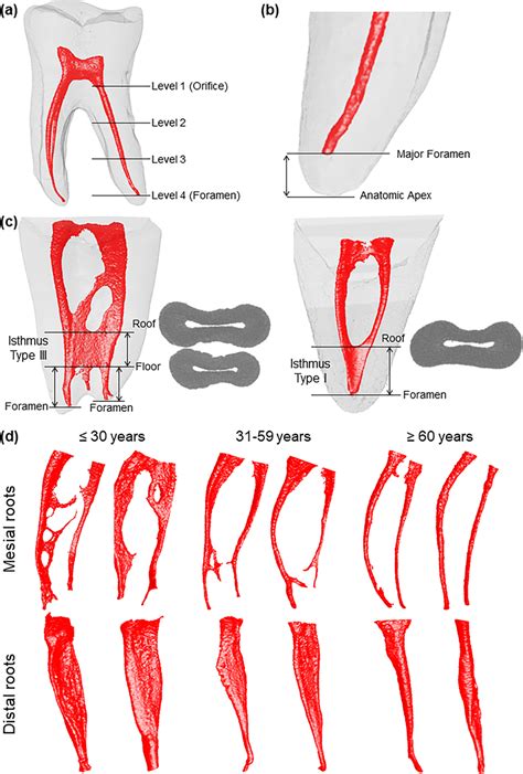 Imaging Analyses A Distal Root With A Root Canal Configuration Type Download Scientific