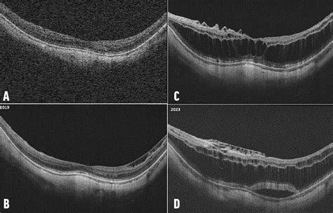 Myopic Traction Maculopathy In A Surgical Setting Retina Today