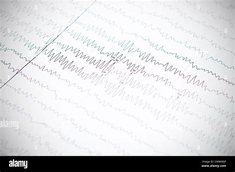 Close Up Eclectroencephalogram Graph On Paper Epilepsy Diagnosis Stock