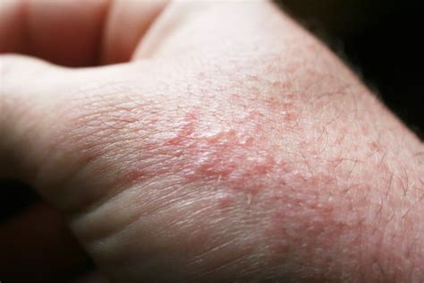 Different Types Of Itchy Skin Rashes