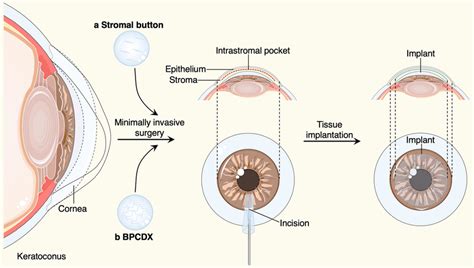 Minimally Invasive Surgical Methods And Bioengineered Grafts For Download Scientific Diagram