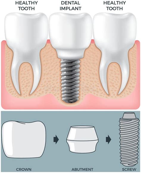 Human Jaw With Normal Healthy Teeth And Prosthesis In Gum Above