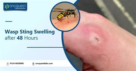 What Alkali Does A Wasp Sting Contain