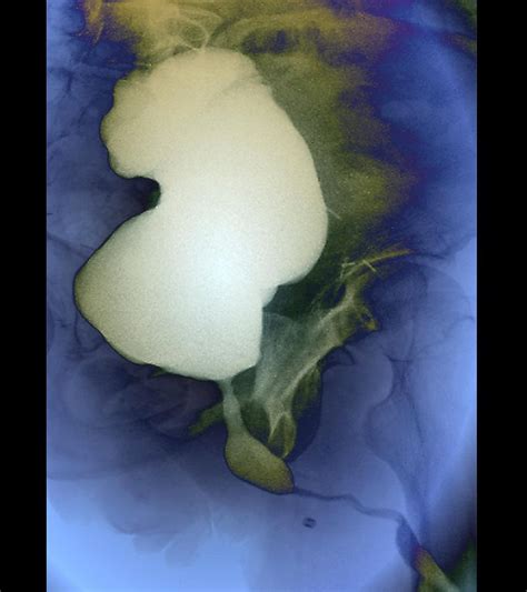 Augmented Bladder Photograph By Zephyrscience Photo Library