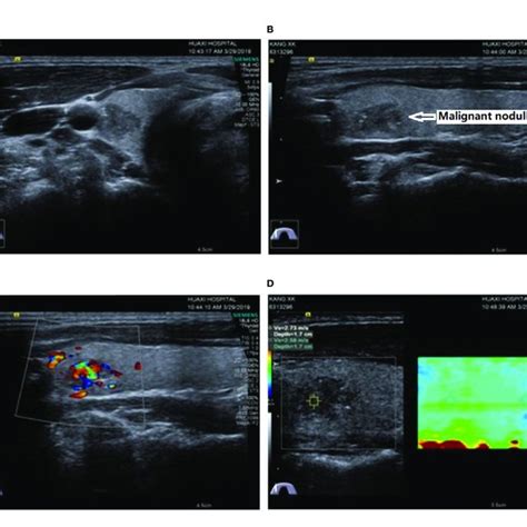 Ultrasound Showed A Solid Hypoechoic And Irregularly Shaped Nodule 13