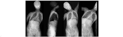 Posterior Anterior Radiograph Showed A 71 ° Coronal Plane Deformity