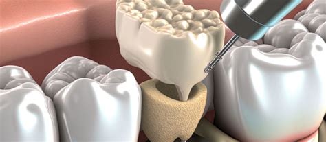 What Happens If I Dont Have A Bone Grafting Procedure Before My Dental