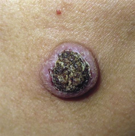 角化棘皮瘤图片 角化棘皮瘤症状图 角化棘皮瘤病例图 皮肤性病科图谱皮肤肿瘤 角化棘皮瘤 爱爱医医学网