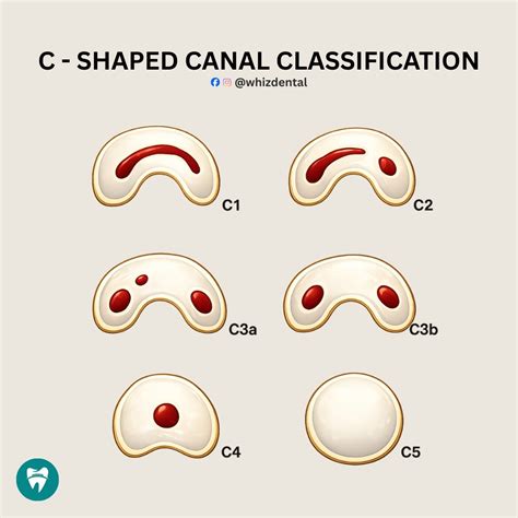 Whiz Graphical Representations Of The C Shaped Canal Configuration