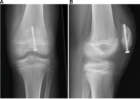 Patella Fracture
