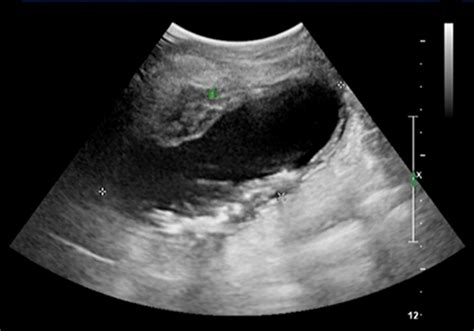 Presentation Of Gallbladder Torsion At An Abnormal Position A Case Report