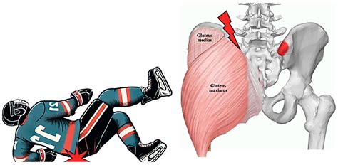 Posterior Hip Pointer Subperiosteal Detachment Of The Gluteal Muscles