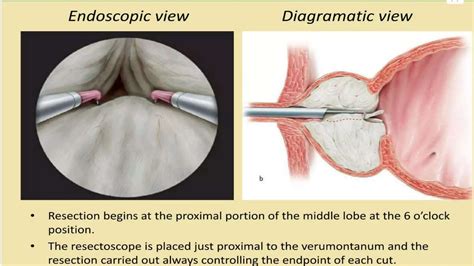 Transurethral Resection Of Prostatepptx