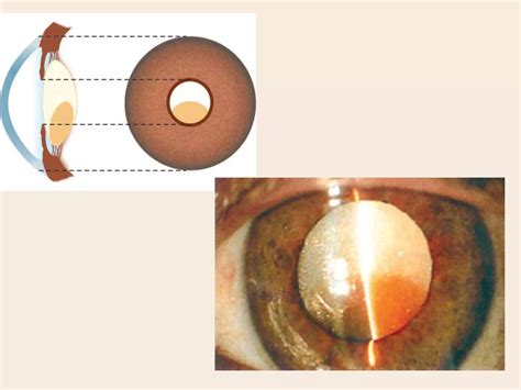 Senile Cataract Quick Revision Ophthalmology Pptx