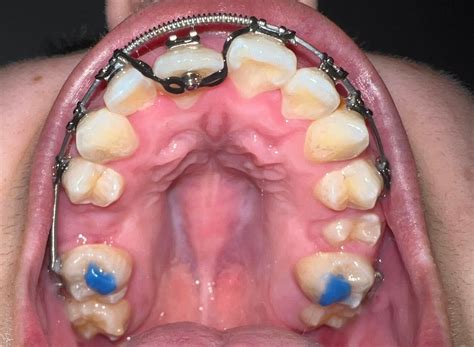 Fun Progress Pics First Is Oct 18th 2nd Is Nov 3rd And Last Is