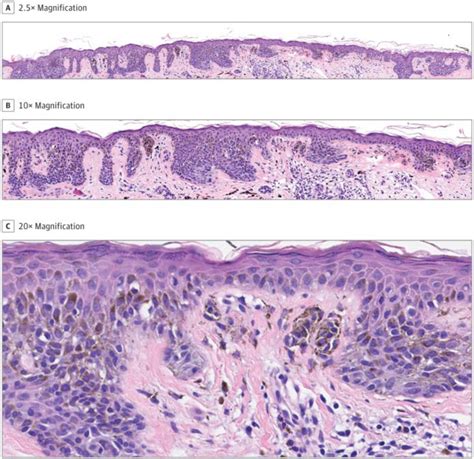 Revision Of The Melanocytic Pathology Assessment Tool And Hierarchy For