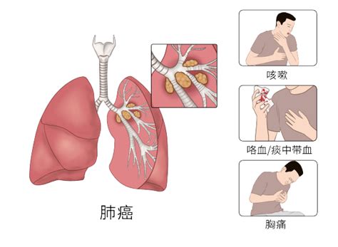 肺癌 医学插画