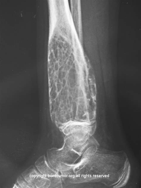 Aneurysmal Bone Cyst Tibia Aneurysmal Bone Cyst Tibia