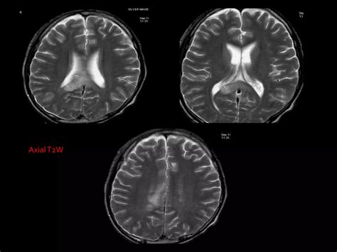 Splenium Hyperintensity Pptx