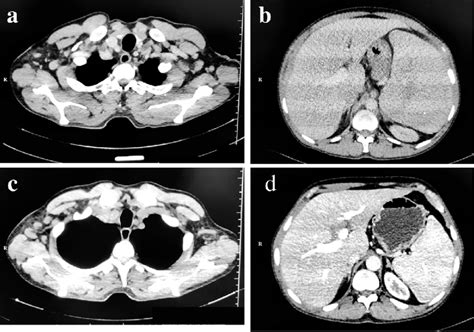 Ct Scan Images Fig 1a And 1b Are Baseline Ct Scan Images Showing