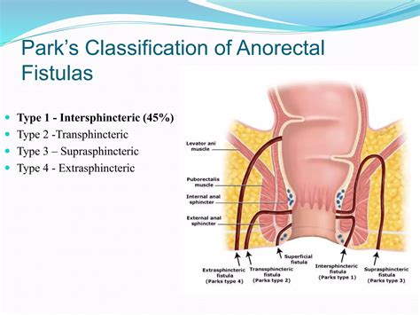Anorectal Fistula Pptx