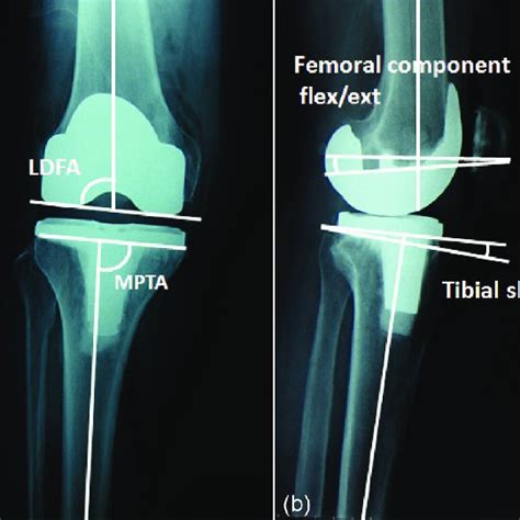 A Front Cutting Mis Tka Instrument Cutting From The Superior To
