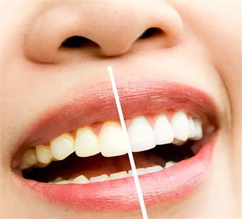 Teeth Whitening Bleaching Dentermis Diş Kliniği