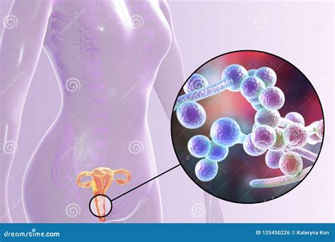 Vaginal Thrush Female Candidiasis Royalty Free Cartoon Cartoondealer