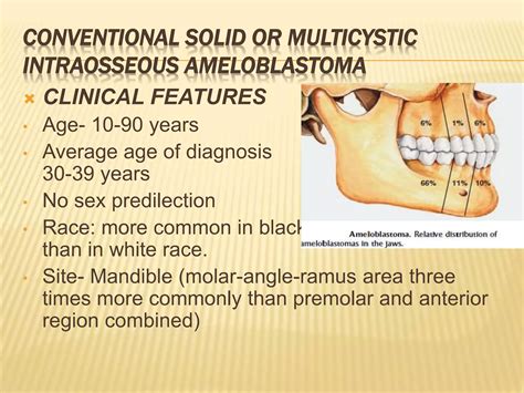 Ameloblastoma Pptx